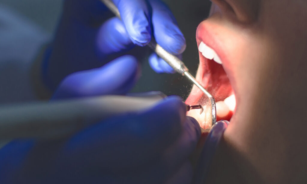 Diş Taşı Temizleme – MSA Dental Clinic